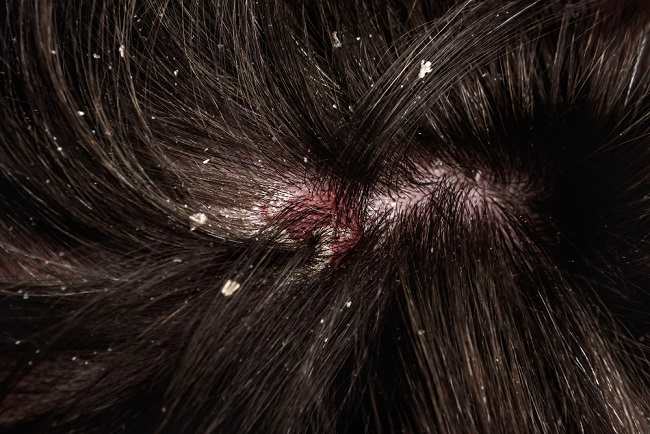 Psoriasis Kulit Kepala, Gejala, Penyebab, dan Penanganan - Alodokter Psoriasis Kulit Kepala, Gejala, Penyebab, dan Penanganan - Alodokter