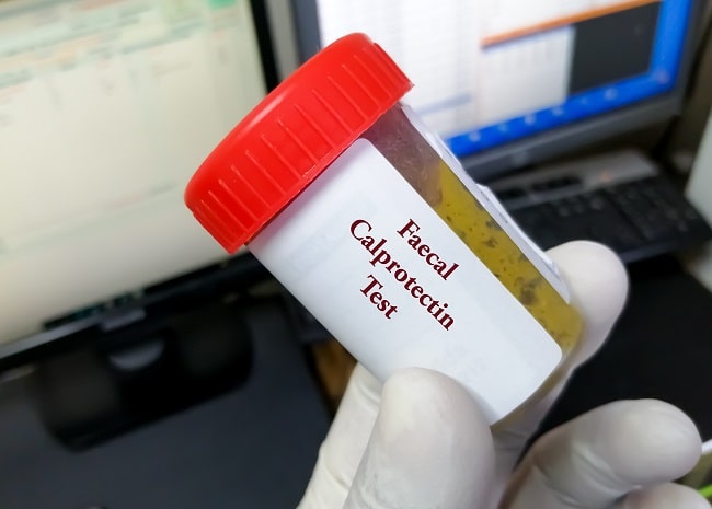Pemeriksaan Fecal Calprotectin untuk Membedakan Inflammatory Bowel ...