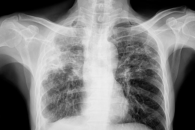 Prognosis Fibrosis Paru Non-Idiopatik - Alomedika