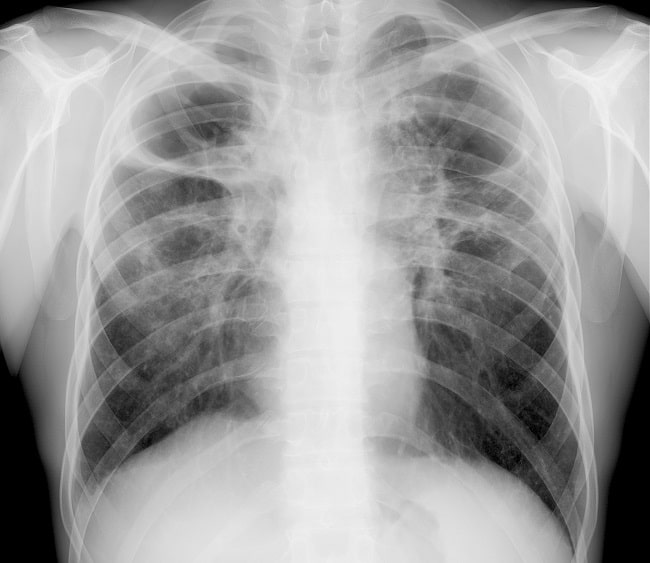 Fibrosis Paru Idiopatik - patofisiologi, diagnosis, penatalaksanaan ...