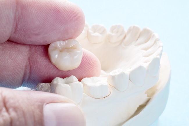 Resin Komposit dan Dental Amalgam untuk Restorasi Gigi Posterior ...
