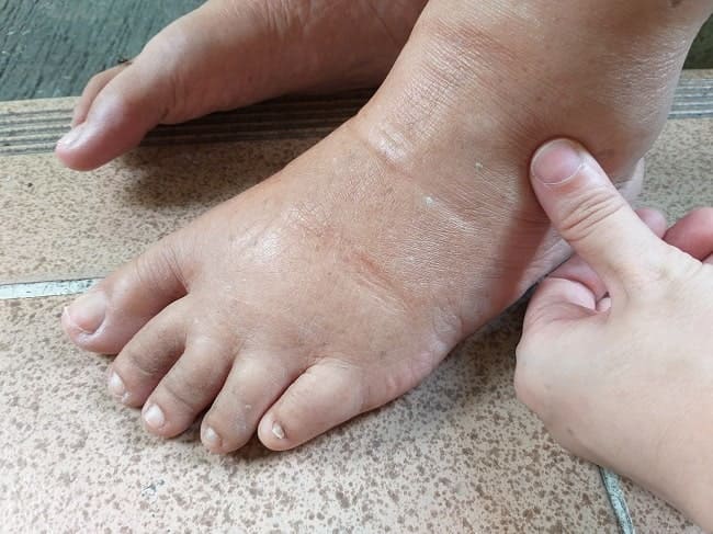 Red Flag Edema Perifer - Alomedika