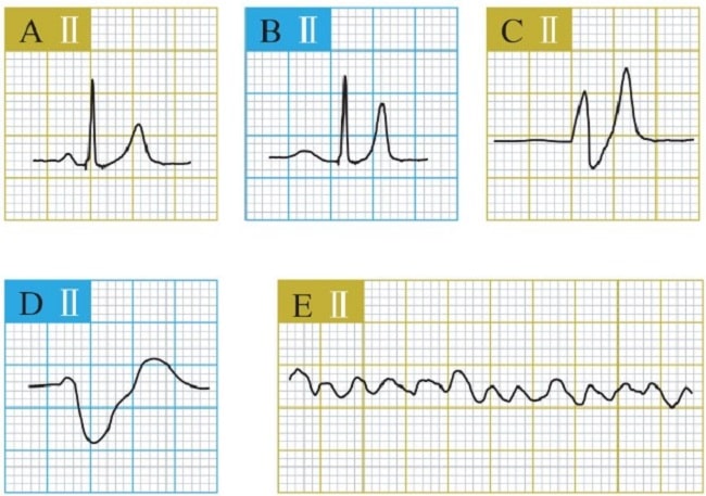 Diagnosis Hiperkalemia - Alomedika