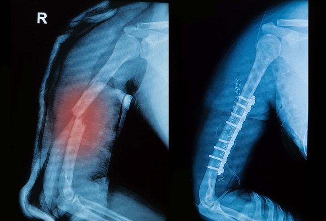 Patah Tulang Lengan Atas - Gejala, Penyebab, dan Pengobatan - Alodokter