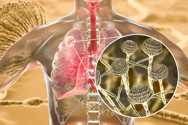 Aspergillosis - patofisiologi, diagnosis, penatalaksanaan - Alomedika