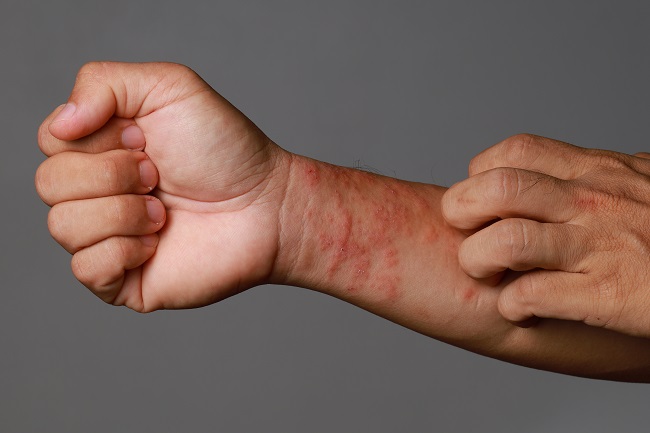 Diagnosis Dermatitis Kontak Alergi - Alomedika