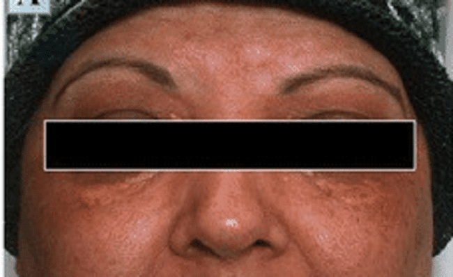 Terapi Laser pada Xanthelasma - Alomedika