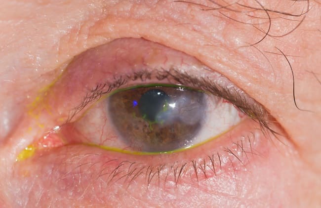 Perbedaan Klinis antara Keratitis Bakteri dan Jamur - Alomedika Perbedaan Klinis antara Keratitis Bakteri dan Jamur - Alomedika