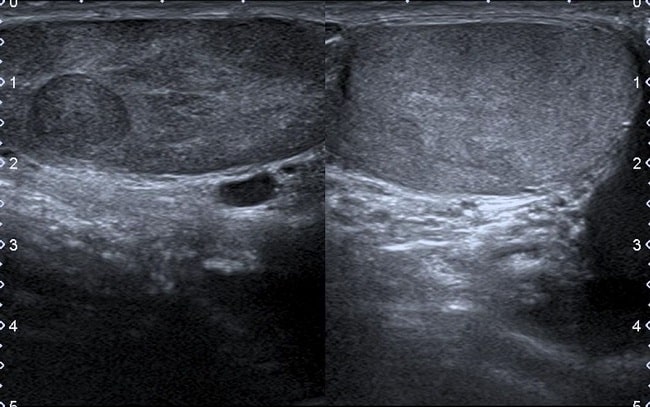 Teknik USG Testis - Alomedika
