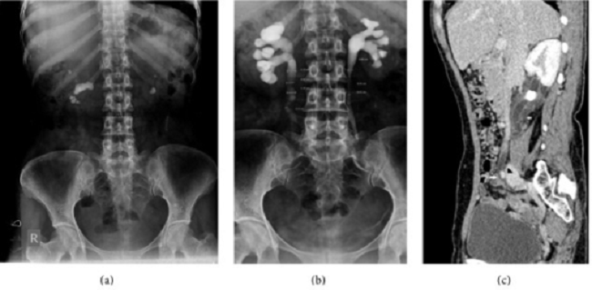 Teknik Intravenous Pyelography - Alomedika