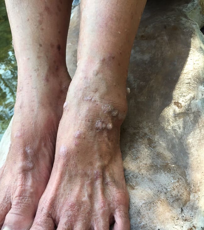 Manajemen Neurodermatitis pada Lansia - Alomedika