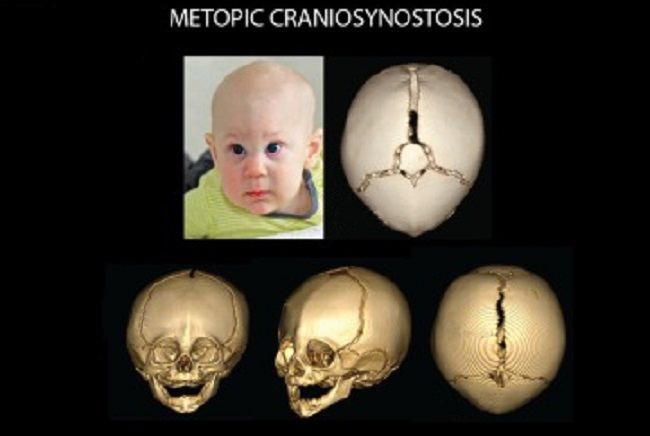 Kraniosinostosis - patofisiologi, diagnosis, penatalaksanaan - Alomedika