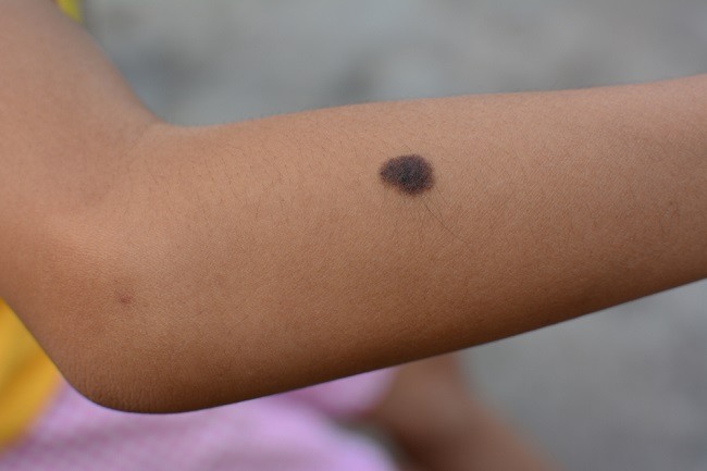 4 Cara Menghilangkan Tompel yang Efektif - Alodokter