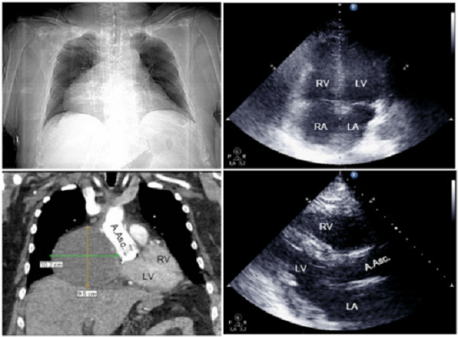 Diagnosis Tamponade Jantung - Alomedika
