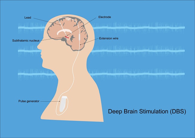 Teknik Deep Brain Stimulation Procedure (DBS) - Alomedika
