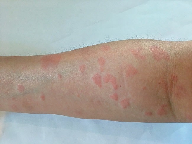 Diagnosis Lupus Eritematosus Sistemik - Alomedika