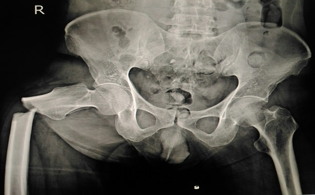 Fraktur Femur - patofisiologi, diagnosis, penatalaksanaan - Alomedika