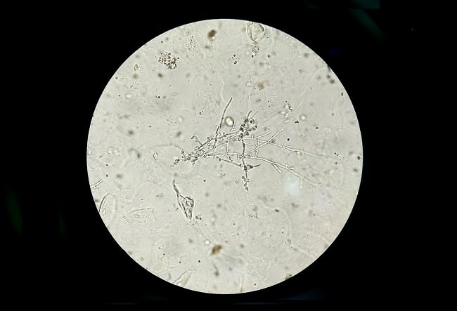 Diagnosis Kandidiasis Vulvovaginal - Alomedika