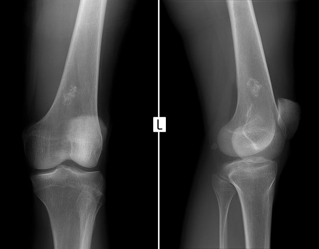Ewing Sarcoma - patofisiologi, diagnosis, penatalaksanaan - Alomedika