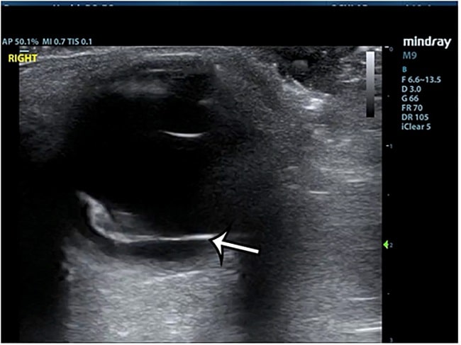 Point-of-Care Ultrasonography untuk Diagnosis Ablatio Retina - Alomedika