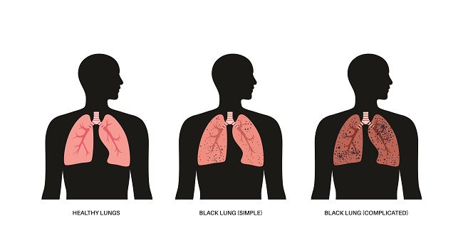 Black Lung Disease - Gejala, Penyebab, dan Pengobatan - Alodokter