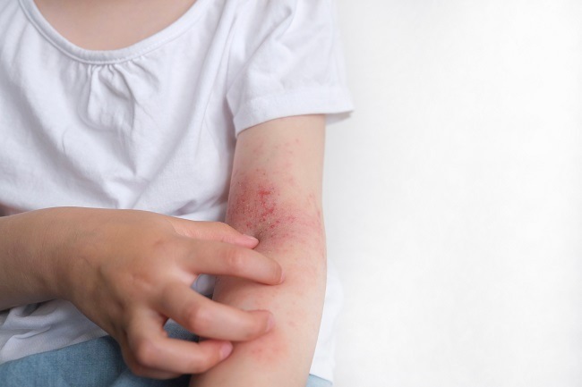 8 Obat Alergi Anak yang Efektif Meredakan Keluhan Alergi - Alodokter