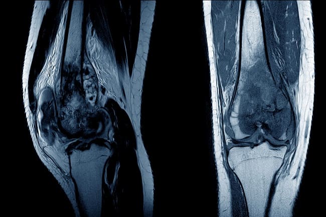 Osteosarkoma: Amputasi Vs Reseksi Limb Salvage - Alomedika