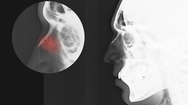 Fraktur Hidung - patofisiologi, diagnosis, penatalaksanaan - Alomedika