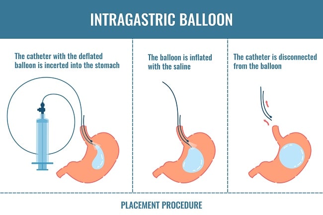 Balon Intragastrik untuk Menurunkan Berat Badan pada Obesitas - Alomedika