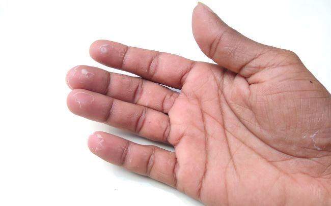 Kulit Jari Tangan Mengelupas, Inilah Penyebab dan Cara Mencegahnya ...