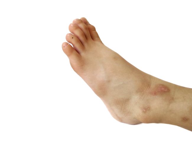 12 Cara Menghilangkan Bekas Luka di Kaki yang Ampuh - Alodokter 12 Cara Menghilangkan Bekas Luka di Kaki yang Ampuh - Alodokter