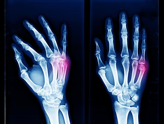 Boxer's Fracture - patofisiologi, diagnosis, penatalaksanaan - Alomedika