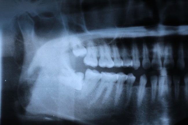 Impaksi Gigi - patofisiologi, diagnosis, penatalaksanaan - Alomedika