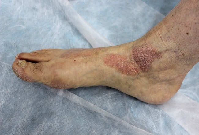 Penatalaksanaan Neurodermatitis - Alomedika