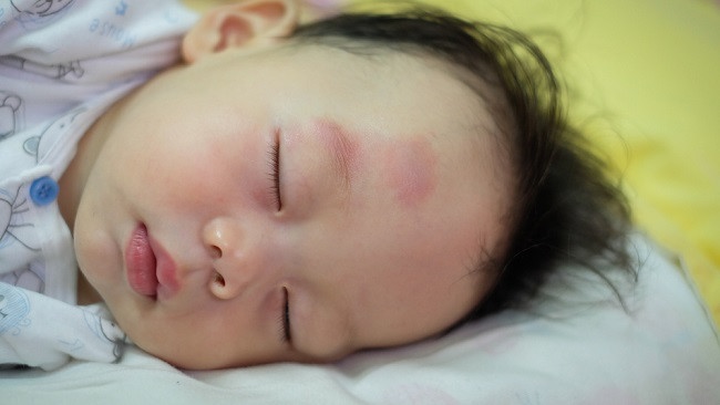 Benjolan di Kepala Bayi, Ketahui Penyebab dan Cara Menanganinya - Alodokter Benjolan di Kepala Bayi, Ketahui Penyebab dan Cara Menanganinya - Alodokter