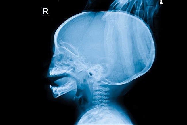 Penyakit Kepala Besar, Kenali Penyebab dan Penanganannya - Alodokter