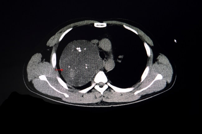 Tumor Mediastinum - patofisiologi, diagnosis, penatalaksanaan - Alomedika