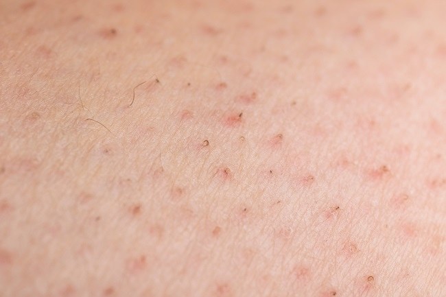 Rambut Tumbuh ke Dalam - Gejala, Penyebab dan Pengobatan - Alodokter