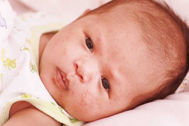 6 Obat Campak pada Bayi yang Aman dan Efektif - Alodokter