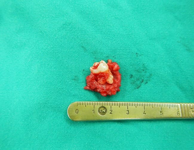 Kista Dentigerous - patofisiologi, diagnosis, penatalaksanaan - Alomedika