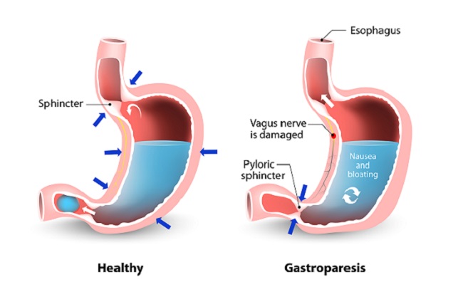 Gastroparesis - patofisiologi, diagnosis, penatalaksanaan - Alomedika