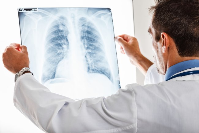 6 Ciri-Ciri Paru-paru Basah yang Perlu Dikenali - Alodokter