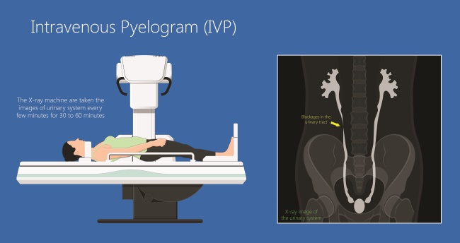 BNO IVP dan Hal-hal Penting di Dalamnya - Alodokter