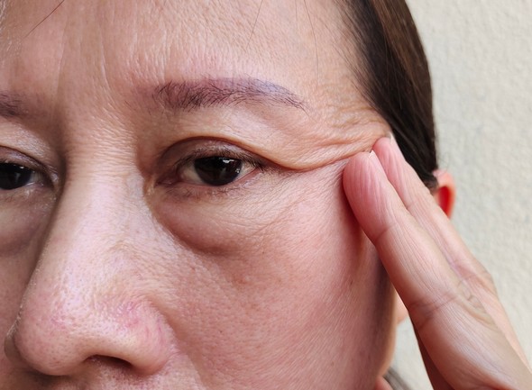 กล้ามเนื้อตาอ่อนแรง (Ocular Myasthenia Gravis) - พบแพทย์