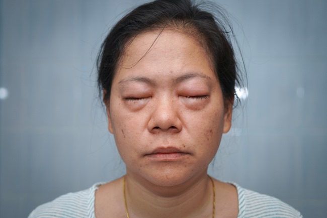 6 Obat Sakit Mata Bengkak yang Ampuh dan Efektif - Alodokter