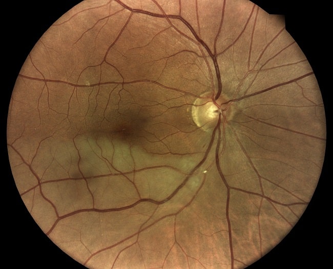 Diagnosis Oklusi Arteri Retina Cabang - Alomedika