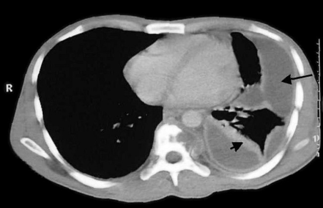 Empiema - patofisiologi, diagnosis, penatalaksanaan - Alomedika