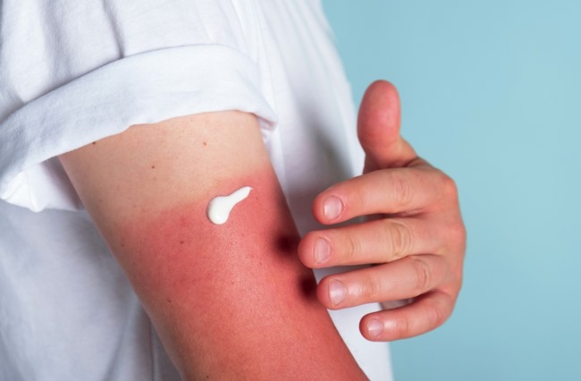 8 Cara Mengatasi Sunburn dan Cara Mencegahnya - Alodokter