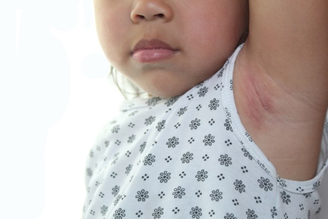 Biang Keringat pada Anak, Inilah Gejala dan Cara Mengatasinya - Alodokter