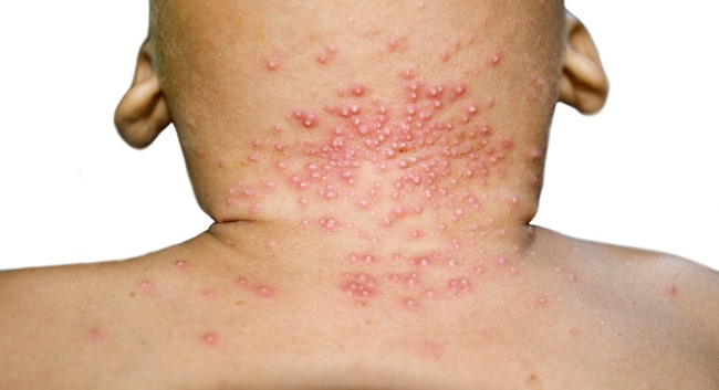 Molluscum Contagiosum - Gejala, Penyebab, dan Pengobatan - Alodokter